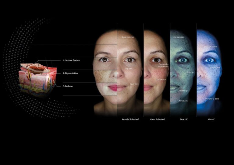 OBSERV®520x Skin Analysis | BU Aesthetics™