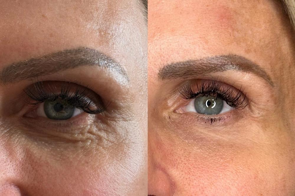 Polynucleotides vs Skin Boosters: Are They The Same?